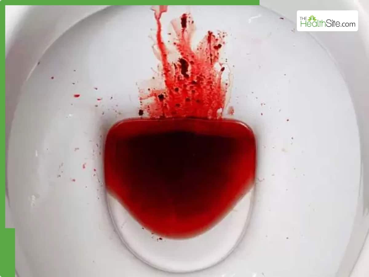 Blood in Stool: What is Rectal Bleeding? Know Causes And Warning Signs You Can’t Ignore ...