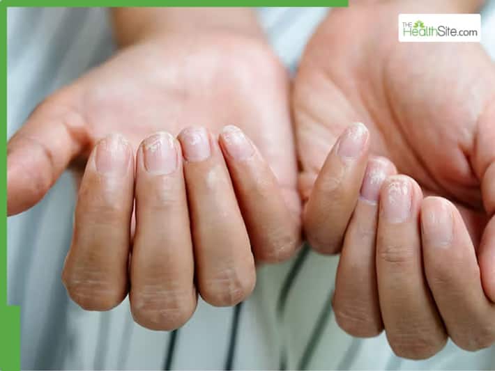 5 Warning Signs of Hypothyroidism Can Show Up In Your Nails ...