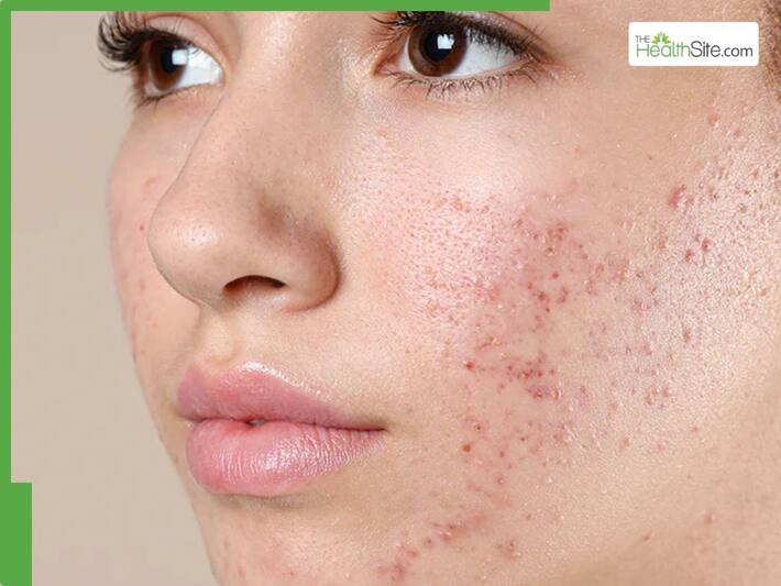 5 Warning Signs of High Cholesterol on the Face You Shouldn't Ignore ...