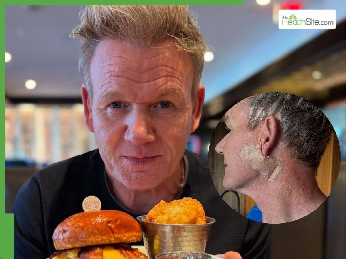 Chef Gordon Ramsay Undergoes Skin Cancer Surgery For Basal Cell ...
