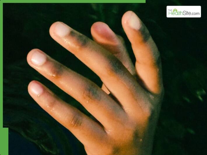 5 Signs Your Finger Nails Signal Serious Heart, Liver Or Other Health ...