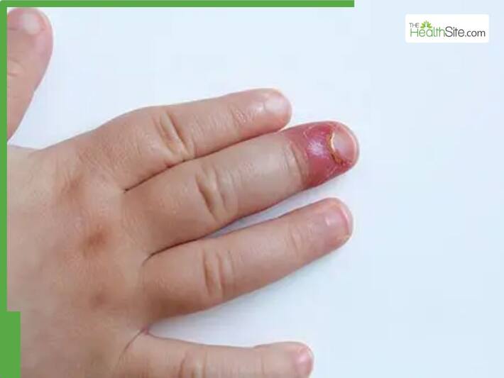 5 Finger Warning Signs That Reveal High Cholesterol | TheHealthSite.com