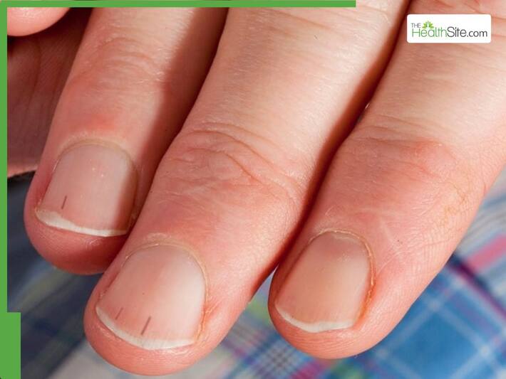 Heart Attack Symptoms: 5 Warning Signs That Appear On Your Nails ...