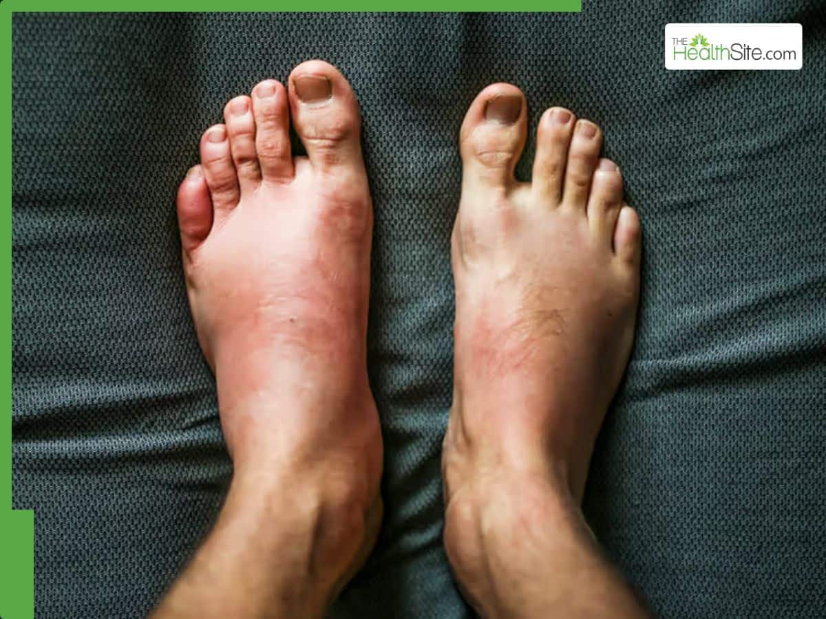 Kidney Failure Symptoms In Legs and Feet: 5 Warning Signs Your Kidneys ...