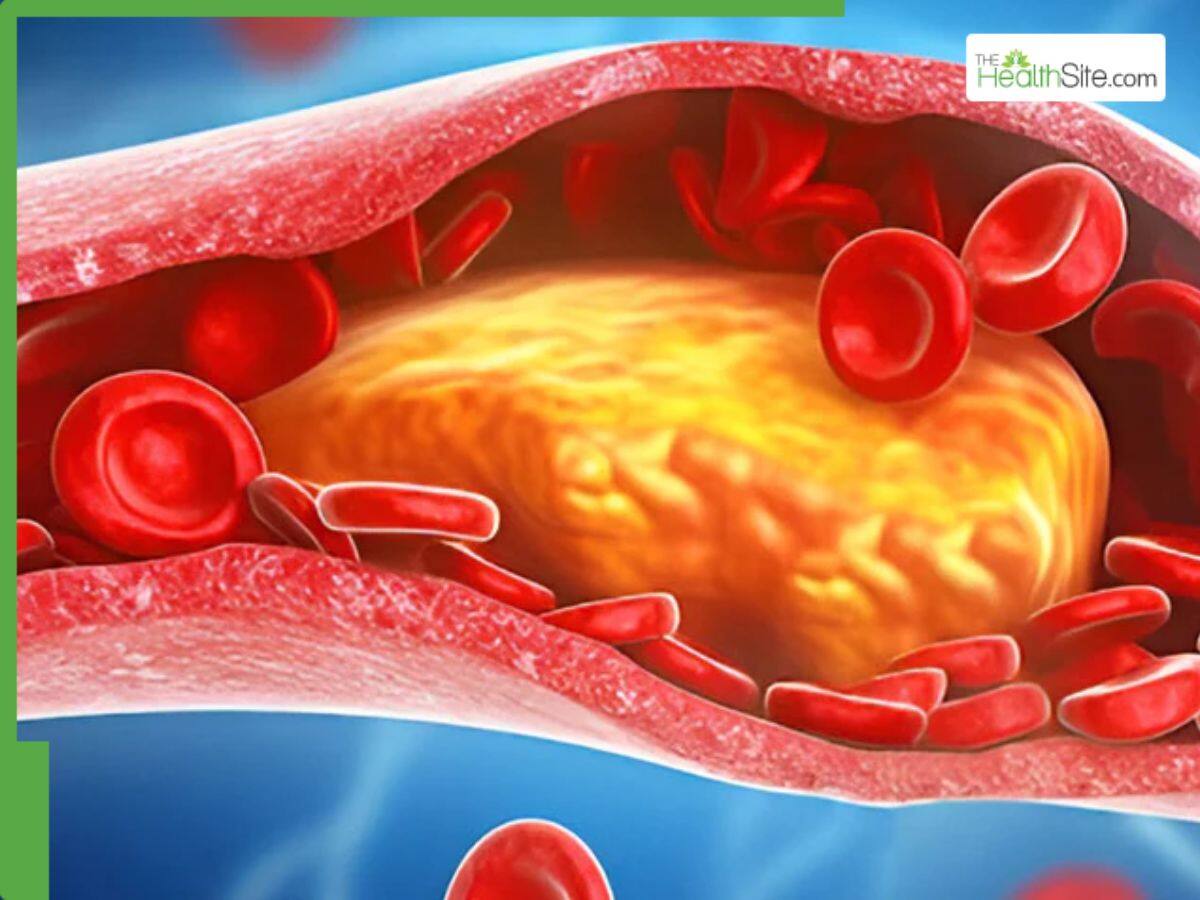 Cholesterol and Brain Health: How High LDL Levels May Trigger Alzheimer ...