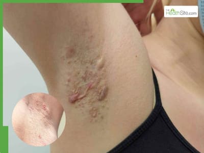 mild shingles armpit