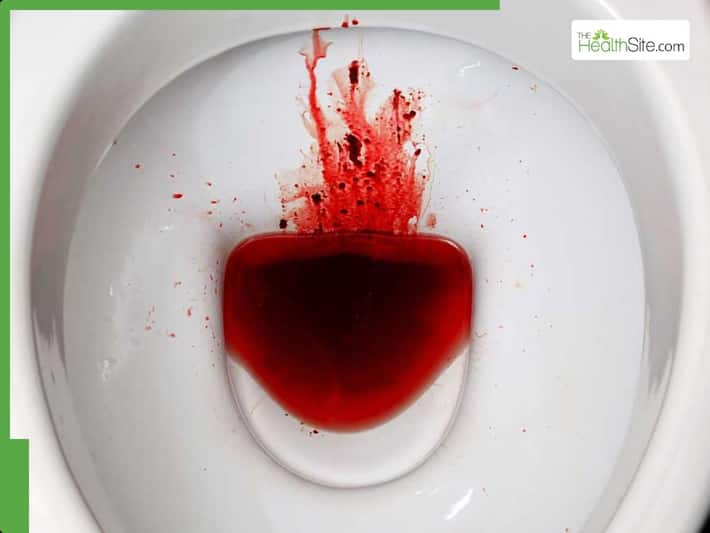 Colon Cancer Symptoms: 5 Early Warning Signs Of Colonic Carcinoma ...