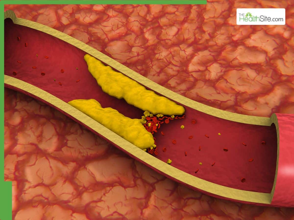 Clogged Arteries Management Tips: 7 Empty Stomach Drinks To Flush Out ...