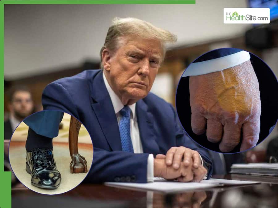Donald Trump Health Update: Chronic Venous Insufficiency To Hand ...