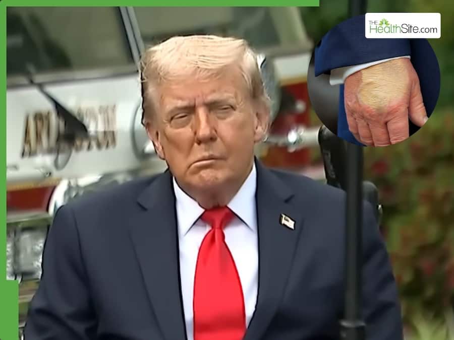 Donald Trump Health Update: Stroke Rumors Trend Online – Other Medical ...