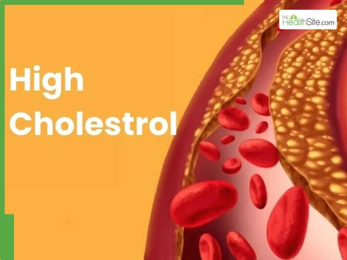 High Cholesterol: 5 Vegetables That Lower LDL Cholesterol And Keep Your ...