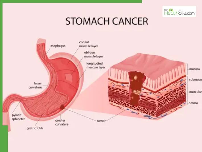 5 Fast-Growing Stomach Cancers Linked to Diet and Lifestyle Choices ...