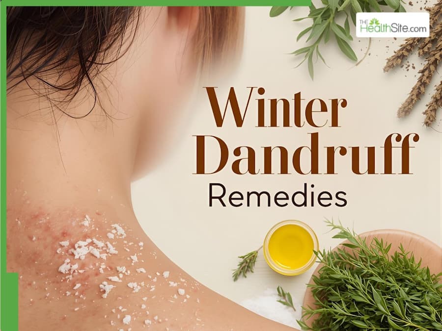 Dandruff In Winter Solutions: Best Ayurvedic Homemade Oils To Soothe ...