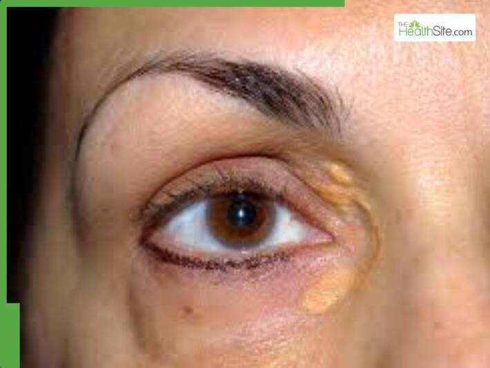 High Cholesterol Symptoms: 5 Warning Signs You May Notice in Your Hands ...