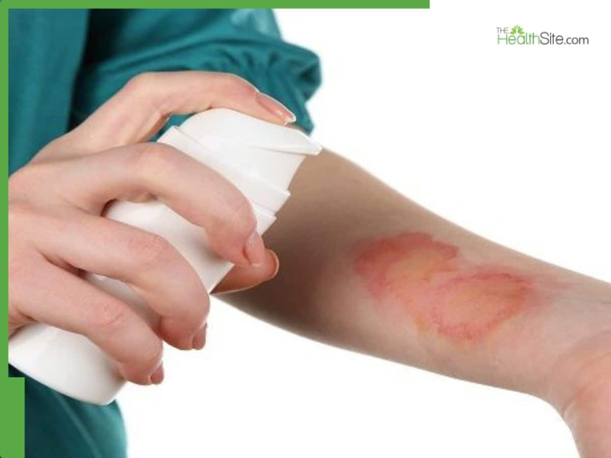 Diwali Safety Tips: How To Manage Cracker Burns At Home ...