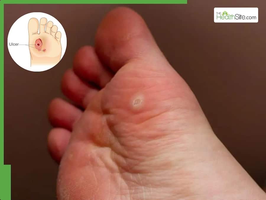 Foot Sores: 5 Diseases That Can Cause Painful Ulcers and Wounds ...