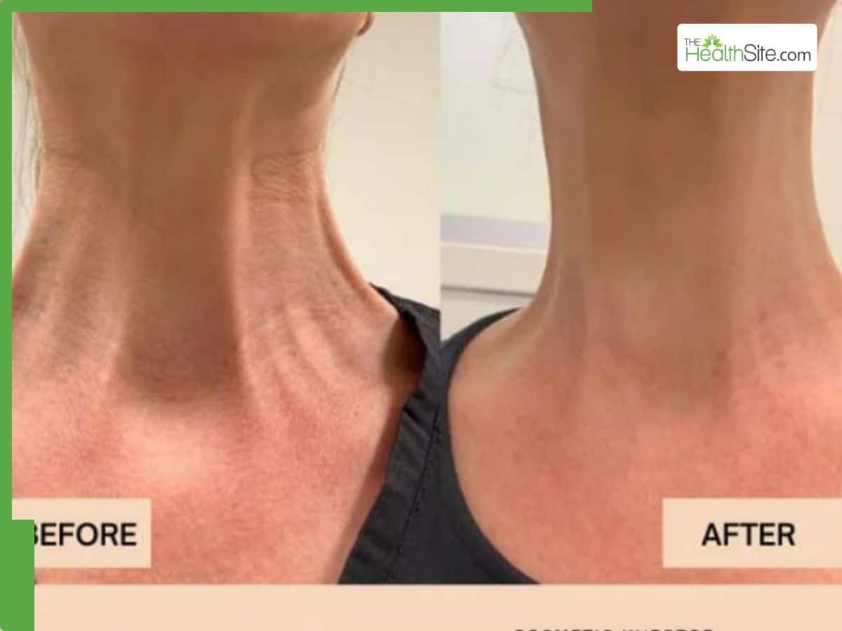 How Can You Remove Neck Lines Naturally and Tighten Sagging Skin? 4 ...