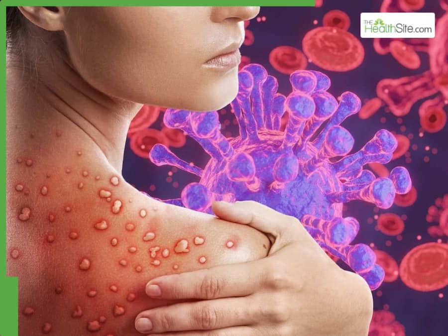 Spain Mpox Alert: First Human Case Of Mpox Clade 1B Confirmed, Symptoms And Prevention Tips ...