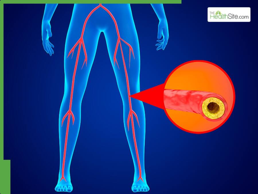 Peripheral Artery Disease: 7 Early Warning Symptoms That Signal Poor ...