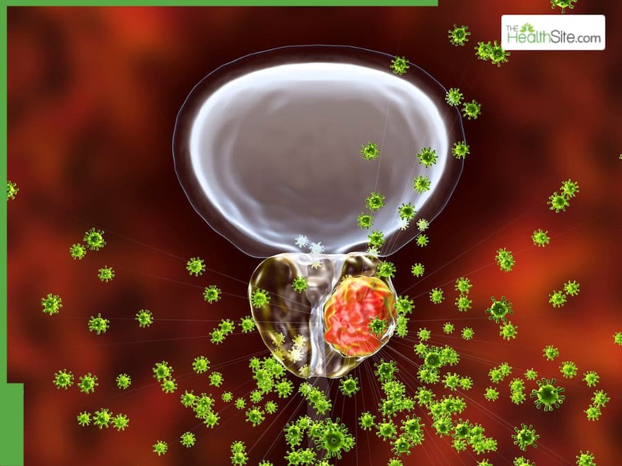 Stages Of Prostate Cancer: The Hard Reality Every Patient Must Know ...