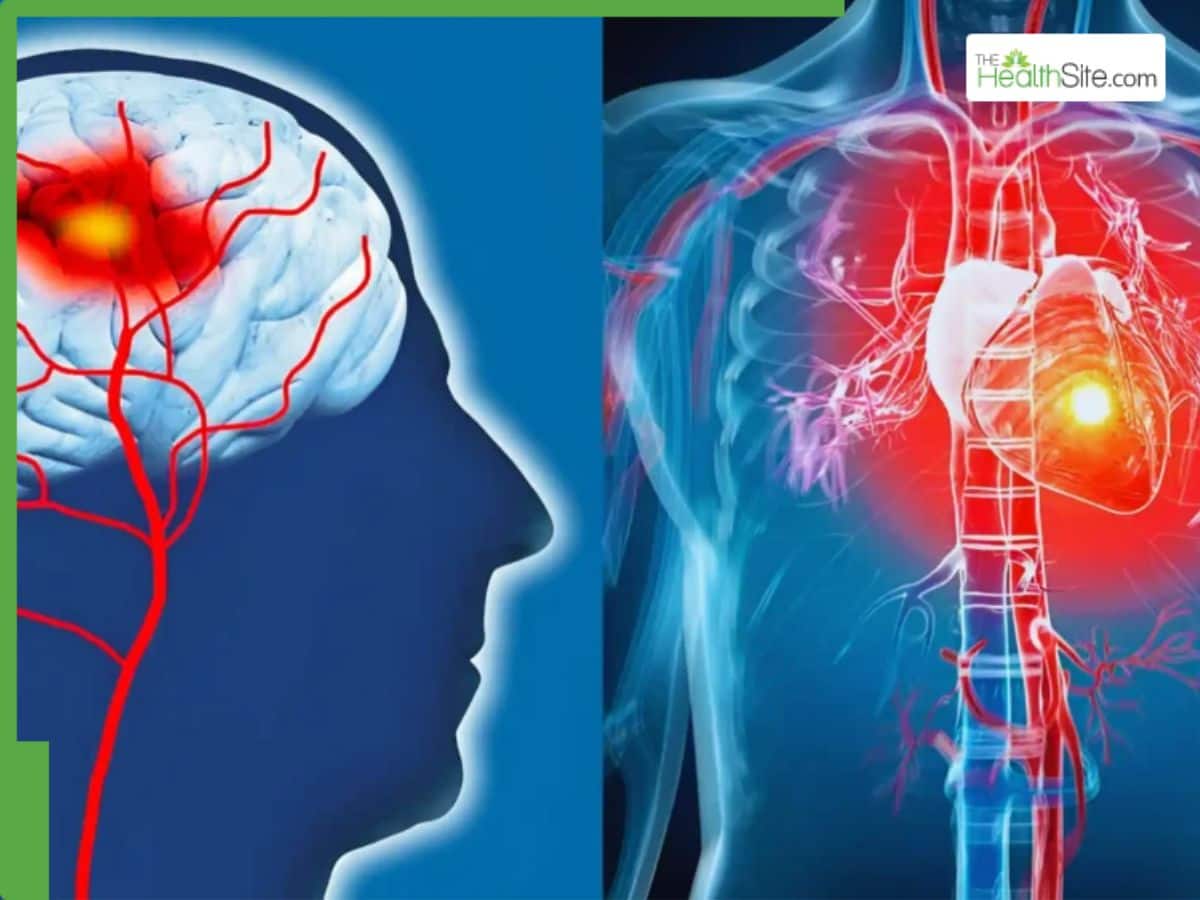 Stroke Vs Heart Attack: What Is The Difference And Which Is Deadlier? | TheHealthSite.com
