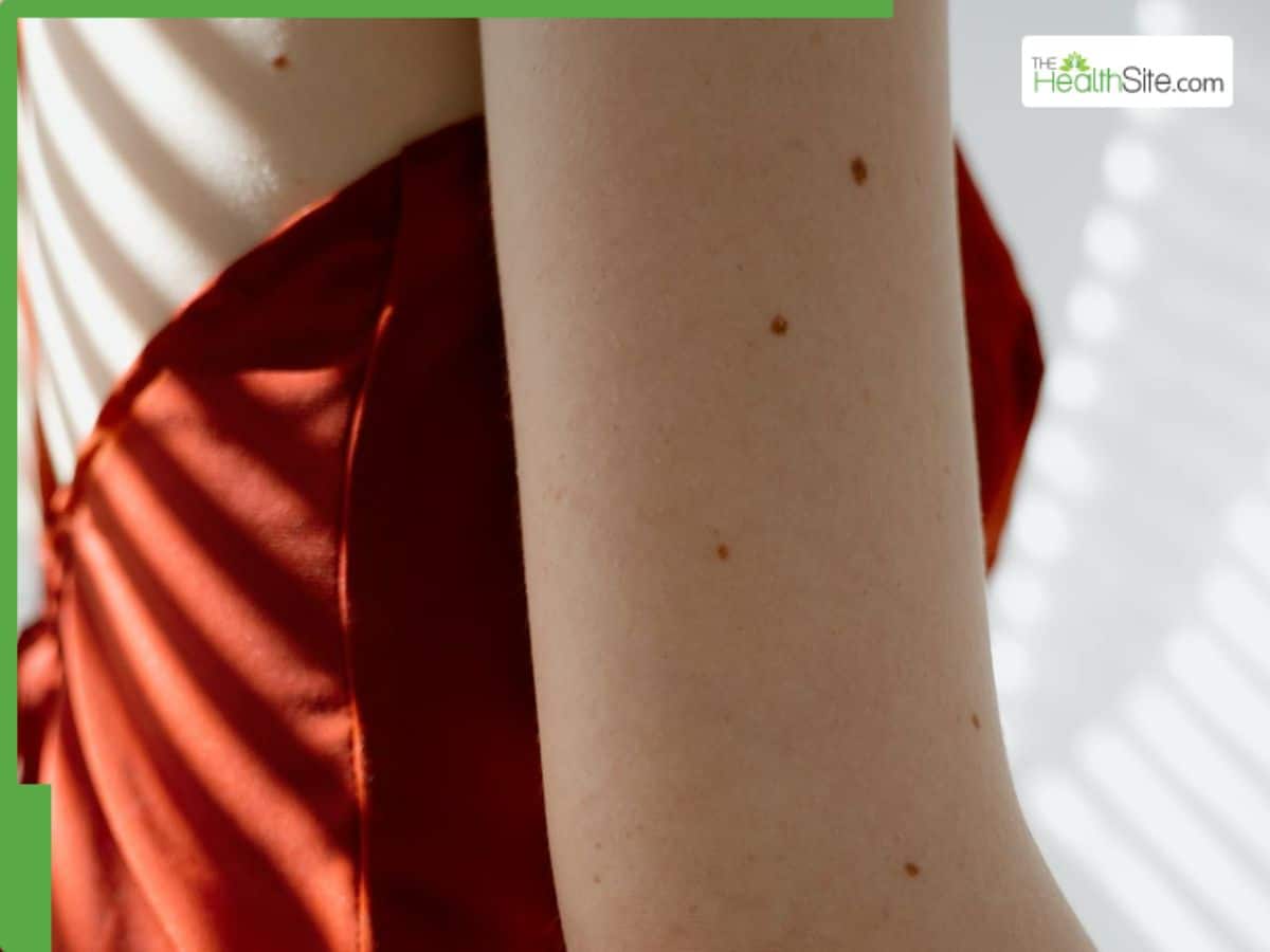 What Are Red Moles? Causes That Result To Cherry Angiomas ...