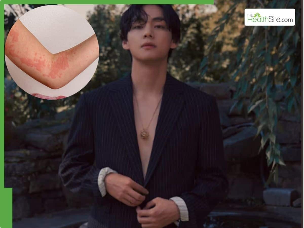 BTS Member V Once Suffered From ‘cholinergic urticaria’: What This ...