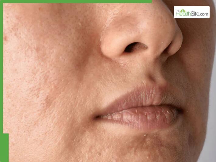 High Cholesterol Symptoms On Face: 5 Warning Signs Of High LDL You ...