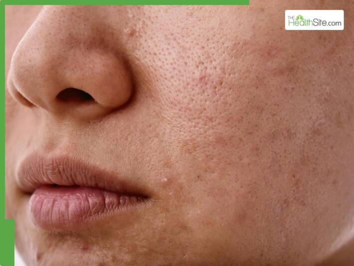 Fatty Liver Symptoms On Face: 5 Early Facial Changes You Should Not ...