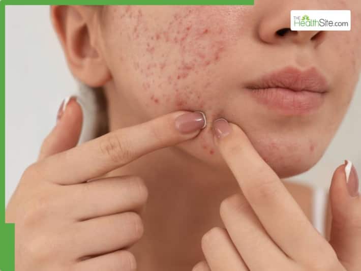 Fatty Liver Symptoms On Face: 5 Early Facial Changes You Should Not ...