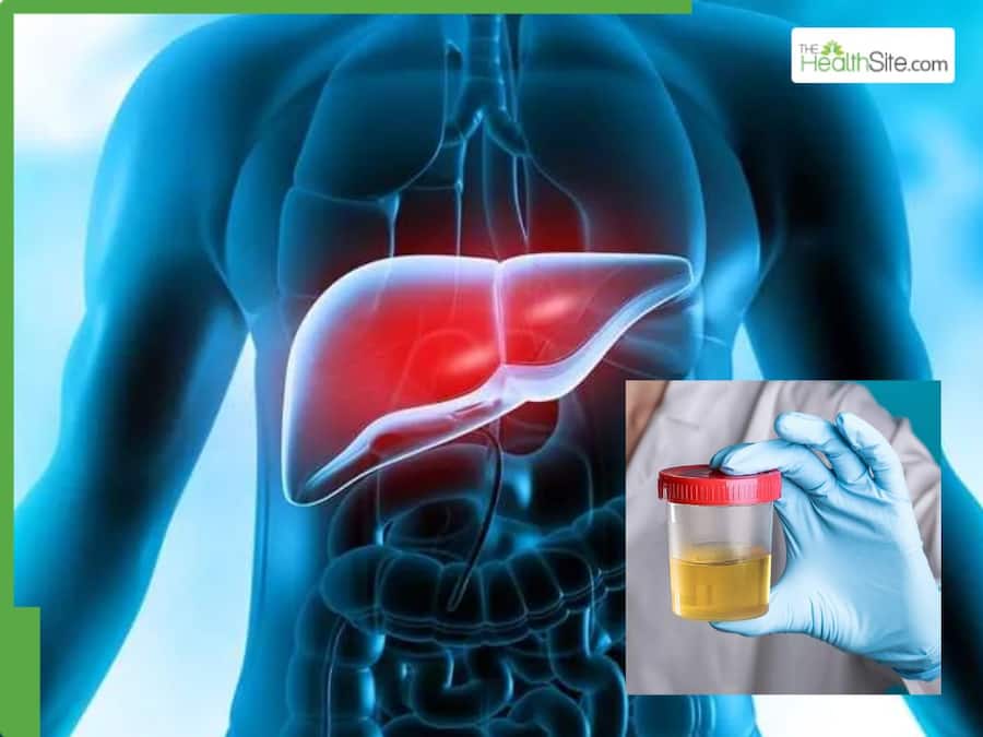 Liver Damage Signs In Your Urine: 7 Early Warning Symptoms You Should ...