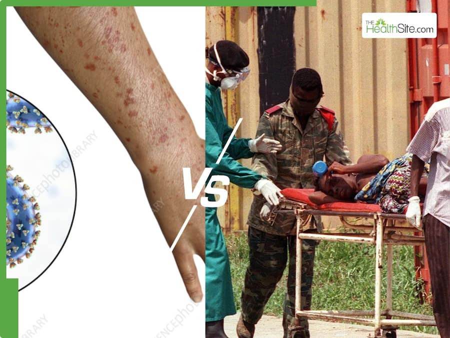 Marburg vs Ebola: What Makes This Virus Even More Deadly and Dangerous ...