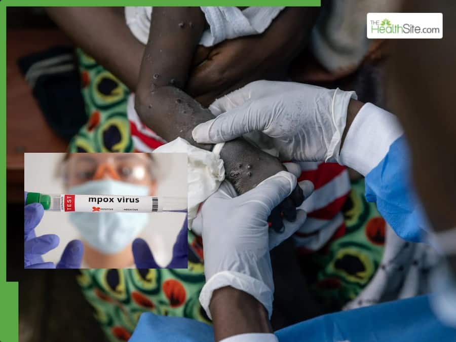 Clade Ib Mpox Cases Surge Worldwide: 17 Deaths Reported In Africa ...