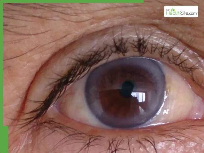 High Cholesterol Symptoms On Face: 5 Warning Signs Of High LDL You ...