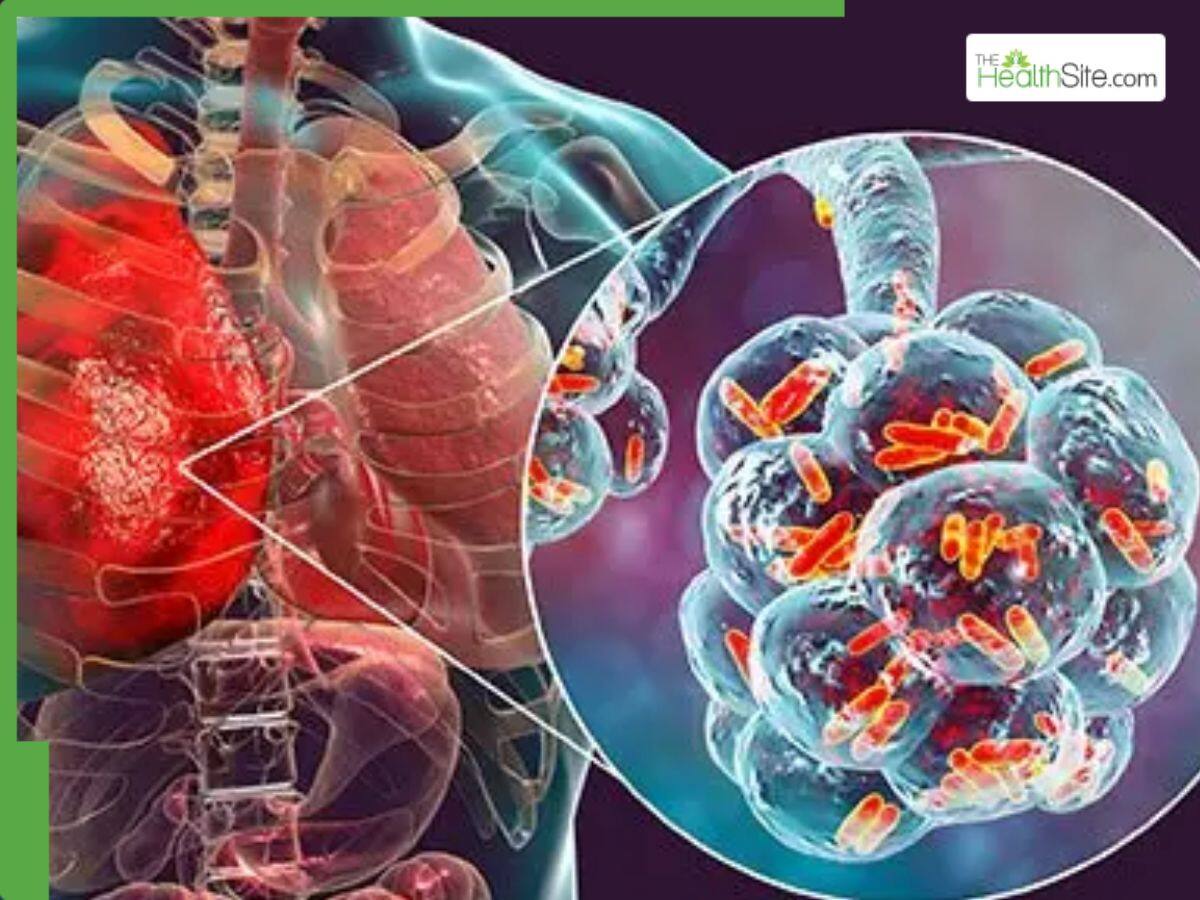 World Pneumonia Day 2025: Top 10 Countries With The Highest Number Of ...