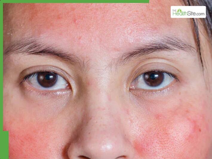 Fatty Liver Symptoms On Face: 5 Early Facial Changes You Should Not ...