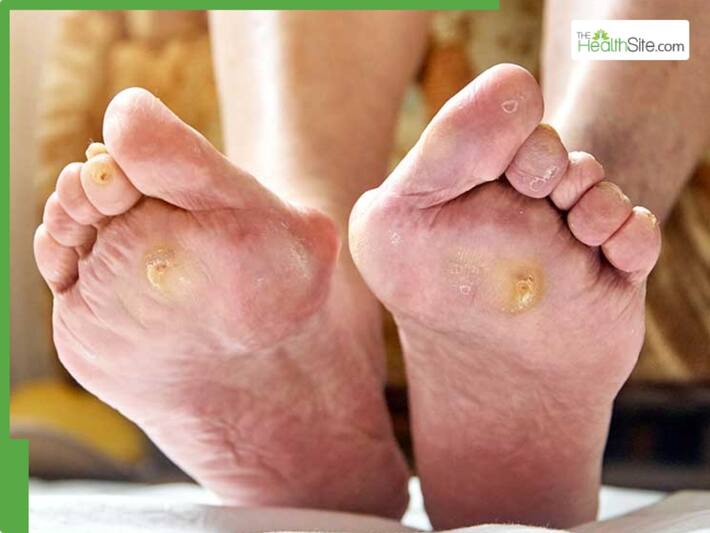 High Cholesterol Symptoms In Feet: 5 Warning Signs Of High LDL You ...