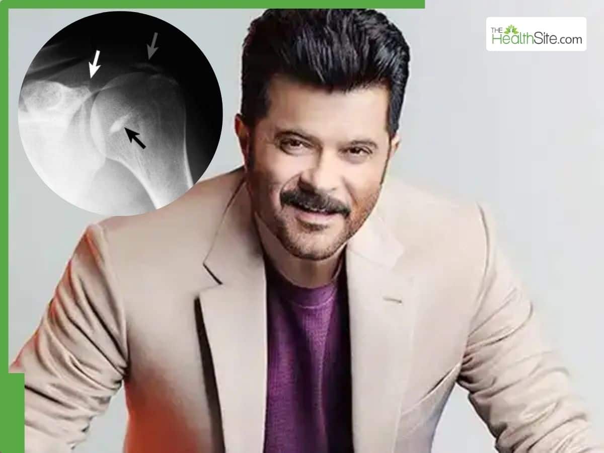 Anil Kapoor Diagnosed With Right Shoulder Calcification: What Does The ...