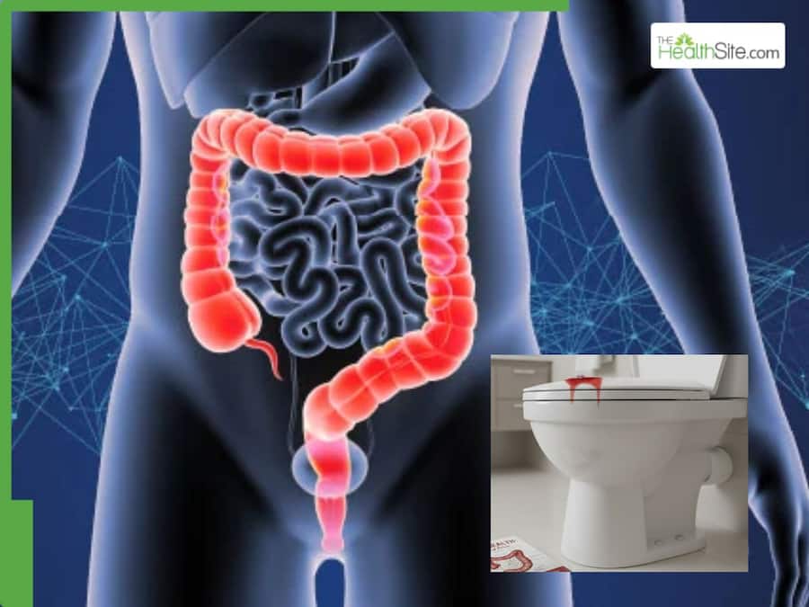 Blood in Stool Isn’t Always Piles: Doctor Reveals Hidden Gut Problems ...
