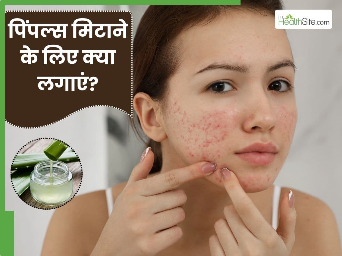 Chehre ke Pimples Kaise Hataye | चेहरे के पिंपल्स से परेशान हैं तो ...