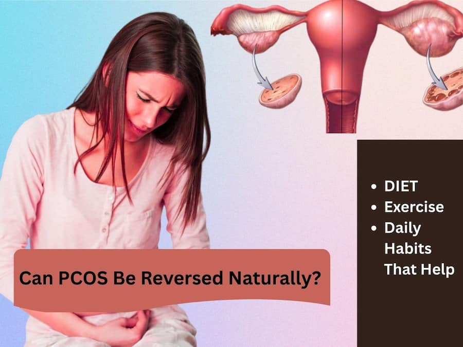Can PCOS Be Reversed Naturally? Diet, Exercise And Daily Habits That ...