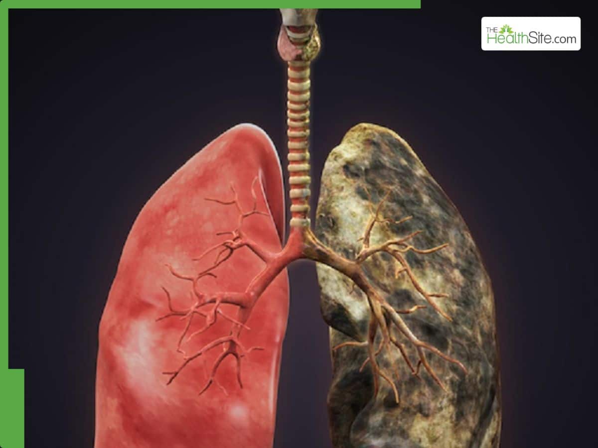 Non-Smokers At Risk: Why Lung Cancer Cases Are Increasing Among People ...