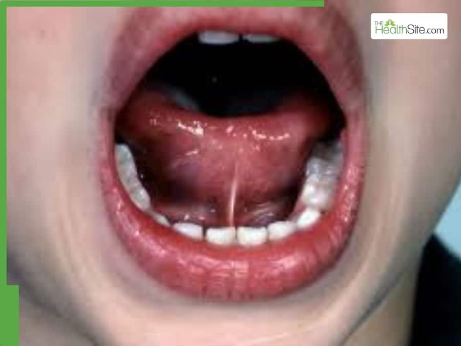 From Sleep Apnea To Jaw Pain: What Is Tongue-Tie? Risks Of Ignoring It ...