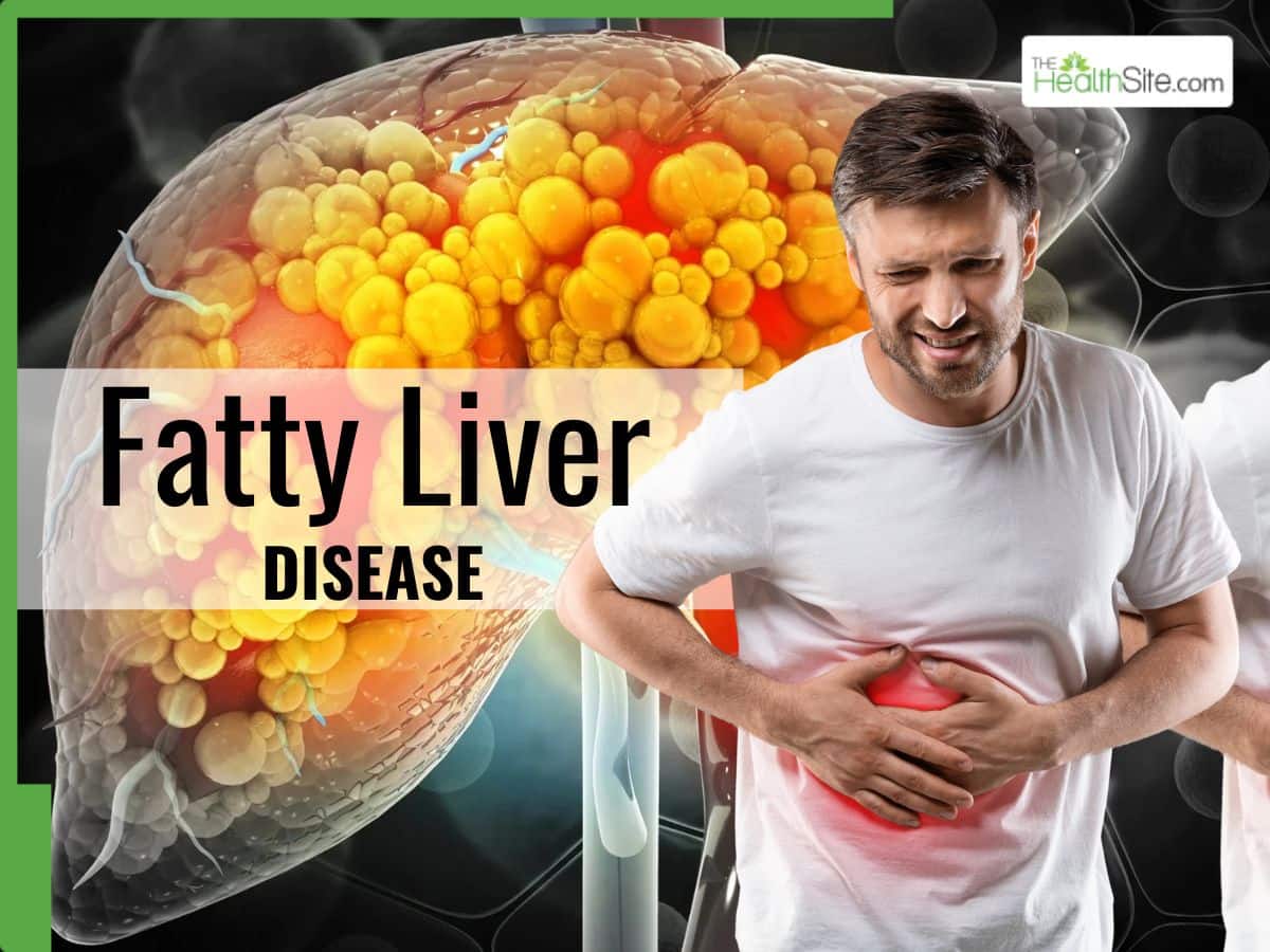 Fatty Liver Disease: NAFLD Hits 1 in 3 Adults in India - Obesity, High ...