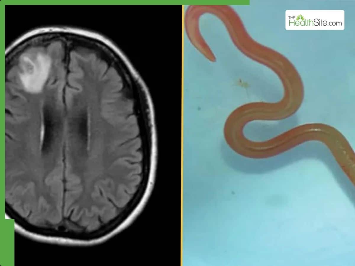 Rare Parasite Discovered In Woman’s Lungs Triggers Organ Damage And ...