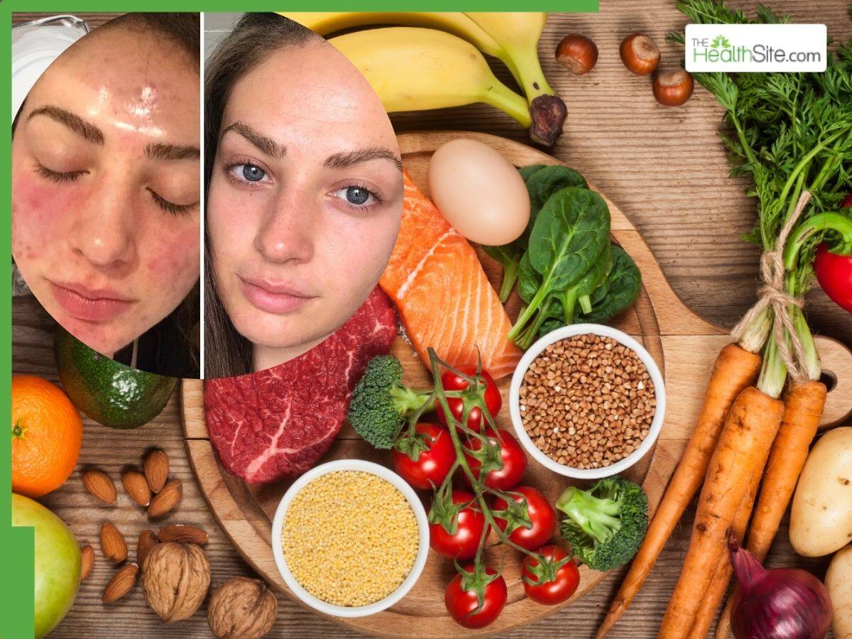 The Diet Acne Connection: Foods That Support Clear Skin And Those That ...