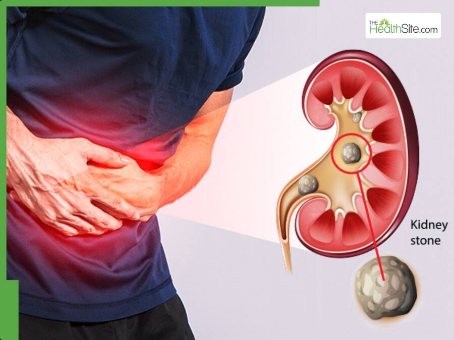 Kidney Stones: Causes, symptoms, treatment and prevention tips to avoid ...