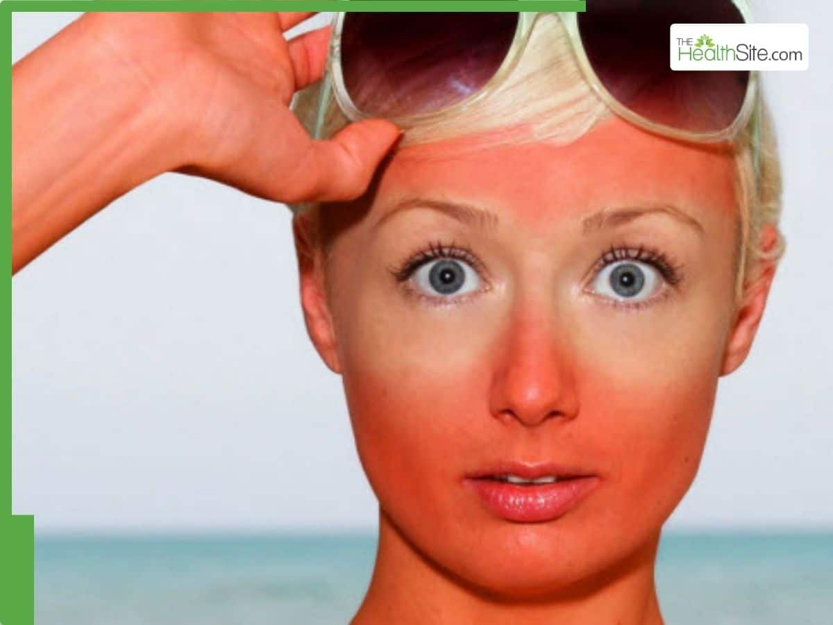 Too much Sun? The risks of prolonged unprotected sun exposure explained ...