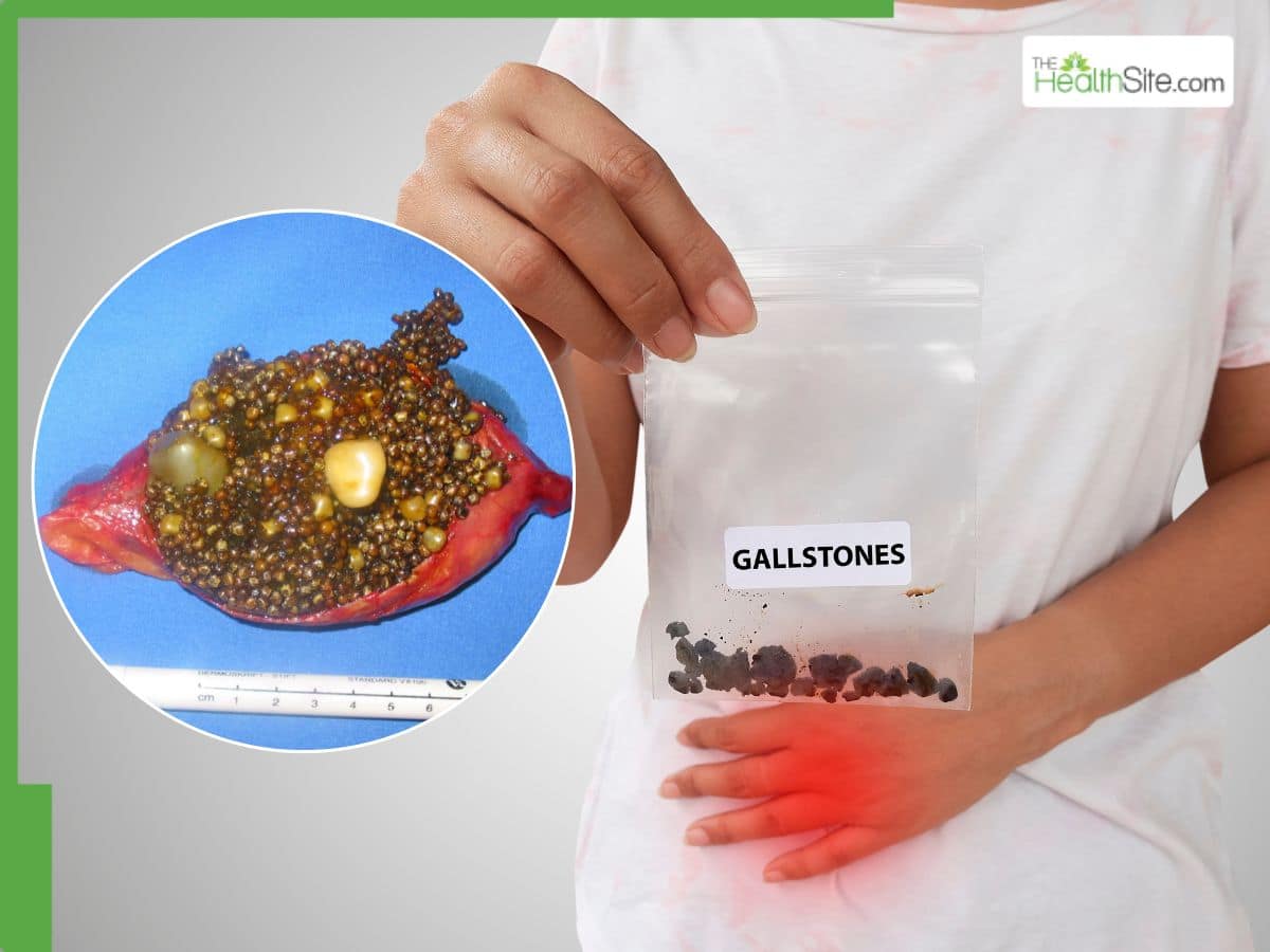 Gallstones symptoms: From dark urine colour to recurrent UTIs - What ...
