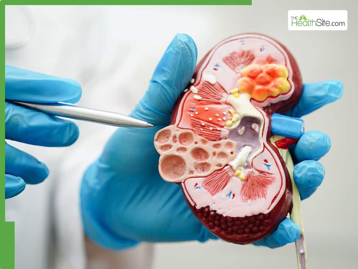 Why kidney diseases are increasing rapidly and the early warning signs ...